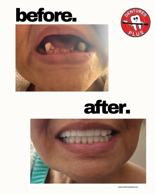 Flipper Tooth Results | Transform Your Smile with Dentures Plus